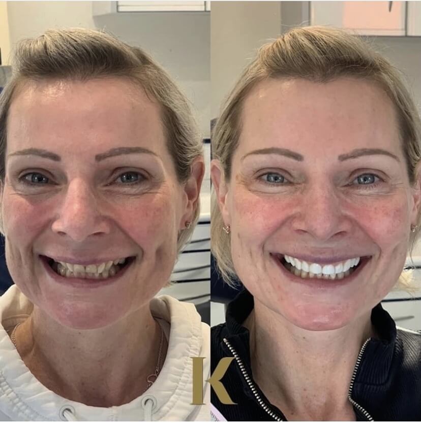 Black Triangle Teeth - St. Helens Dentist - Kiln Lane Dental